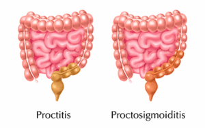 Proctitis | ¿Qué es y cómo se trata?